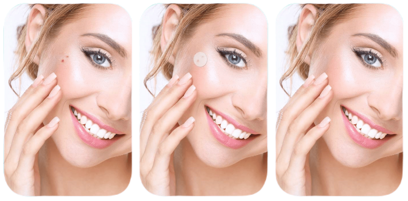 Flasteri za-ukljanjanje-bradavica-i-akni-tronshop.me